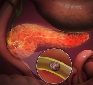 Acute Pancreatitis - About, Cause, Treatment & Symptoms - Dr. Vikas Singla