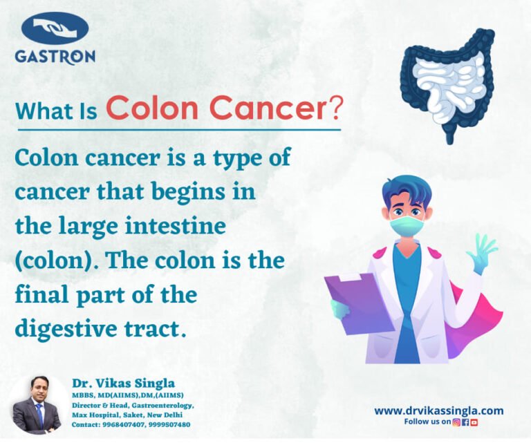 Know about the Colon Cancer - Dr. Vikas Singla