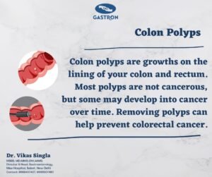 Colon Polyps: Causes, Symptoms and Preventions - Dr. Vikas Singla