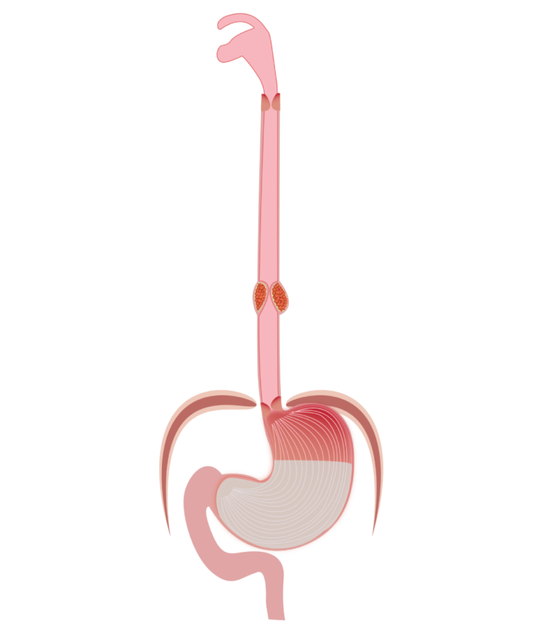 Esophageal Stricture: Causes, Symptoms, and Treatment - Dr. Vikas Singla